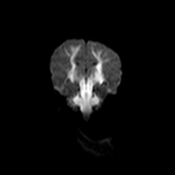 IRRADIATED - Radiology: Maple Syrup Urine Disease (MSUD)