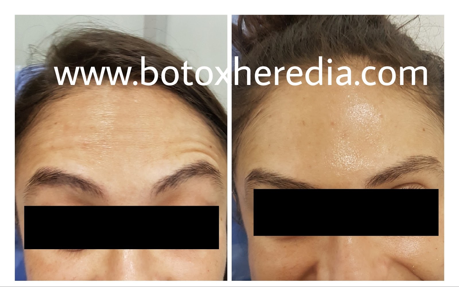 Botox, Acido Hialurónico, Bichectomia, Invisible Touch Hilos Pdo