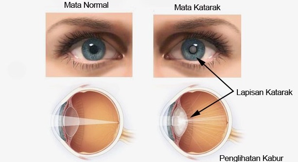 Gejala, Penyebab Dan Pengobatan Penyakit Katarak Pada Anak Dan Lansia ...