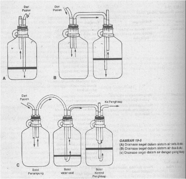web_blog: prosedur pemasangan, perawatan,pencabutan WATER SEAL DRAINAGE ...