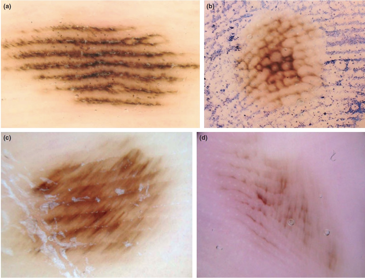 Dermapixel: ¿Por qué los nevus acrales tienen tan mala fama?