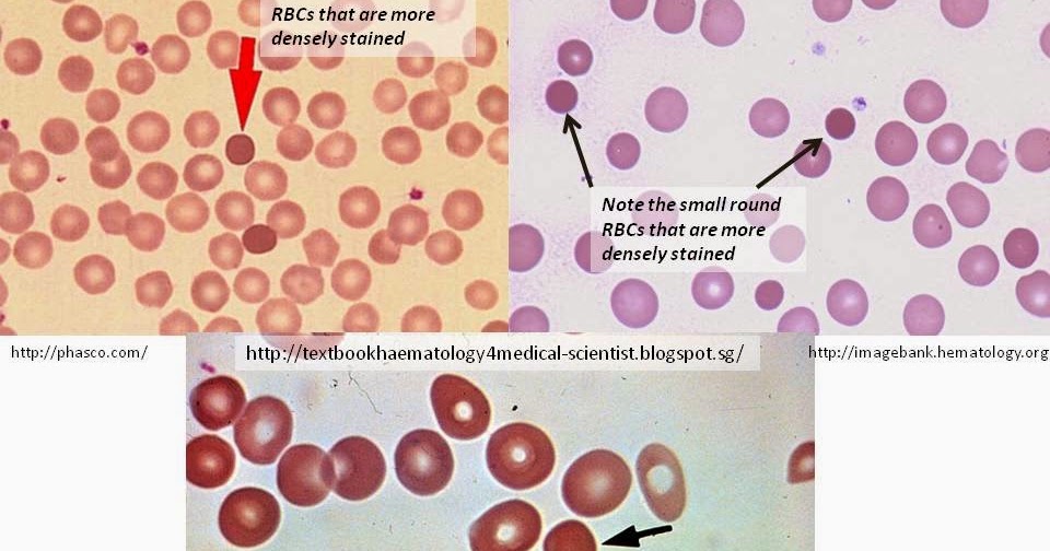 Haematology in a NutShell: Spherocytes