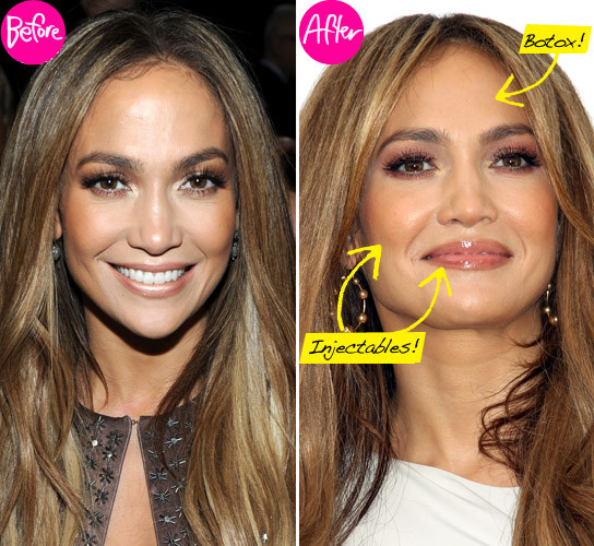 Jennifer Lopez Plastic Surgery Before and After Botox Injections ...