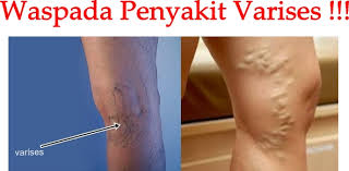 Artikel Kesehatan: Penyebab Varises Di Kaki Dan Pengobatanya
