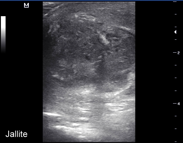 Tuberculosis Testicular