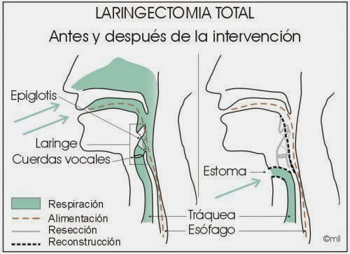 Ayuda al Laringectomizado: LARINGECTOMIA Y TRAQUEOTOMIA