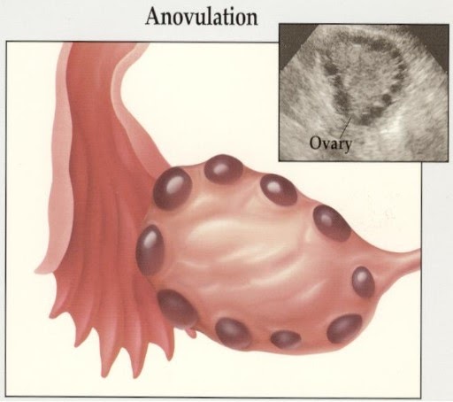 Women's Health and Wellness: Polycystic Ovarian Syndrome (PCOS) (Stein ...