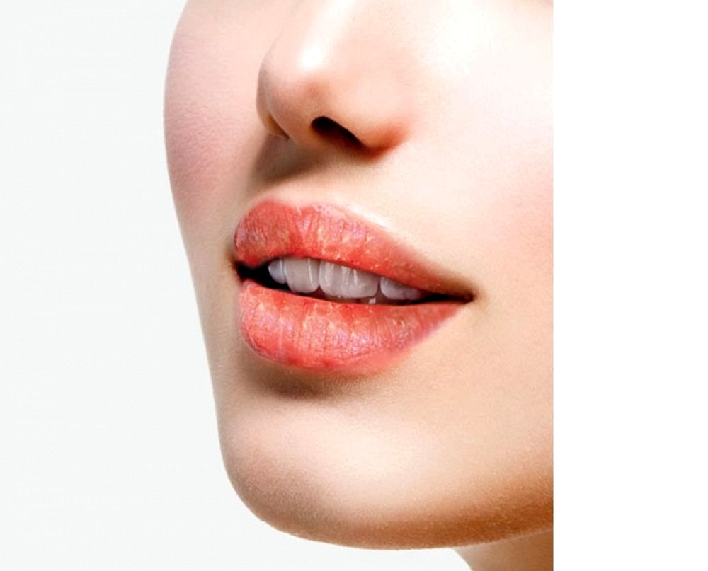 What Causes Chapped Lips Directorio Odontol gico what-causes-chapped-lips-directorio-odontol-gico