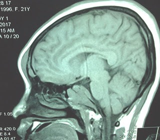 VIETNAMESE MEDIC ULTRASOUND: CASE 425: FRONTAL BONE TUMOR, Dr PHAN ...