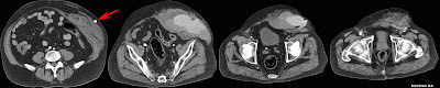 Roentgen Ray Reader: Traumatic Fracture of an Axillofemoral Bypass Graft