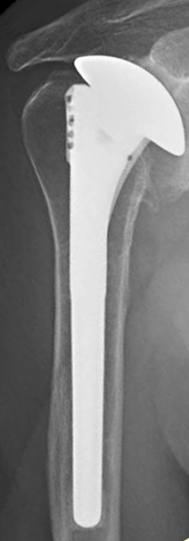 Shoulder Arthritis / Joint Replacement : Short-stem humeral components ...