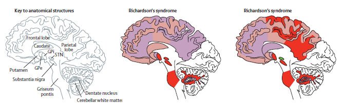 NeuroAnatomía Dr. William Ganem: Parálisis Supranuclear Progresiva ...