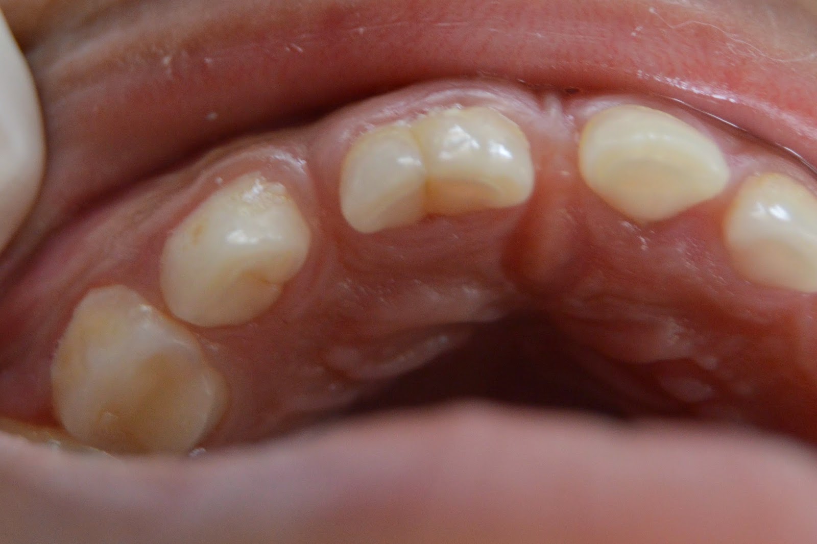 Internado Periférico: Chilca 2014-1: Fusión dental en 3er grado de Primaria