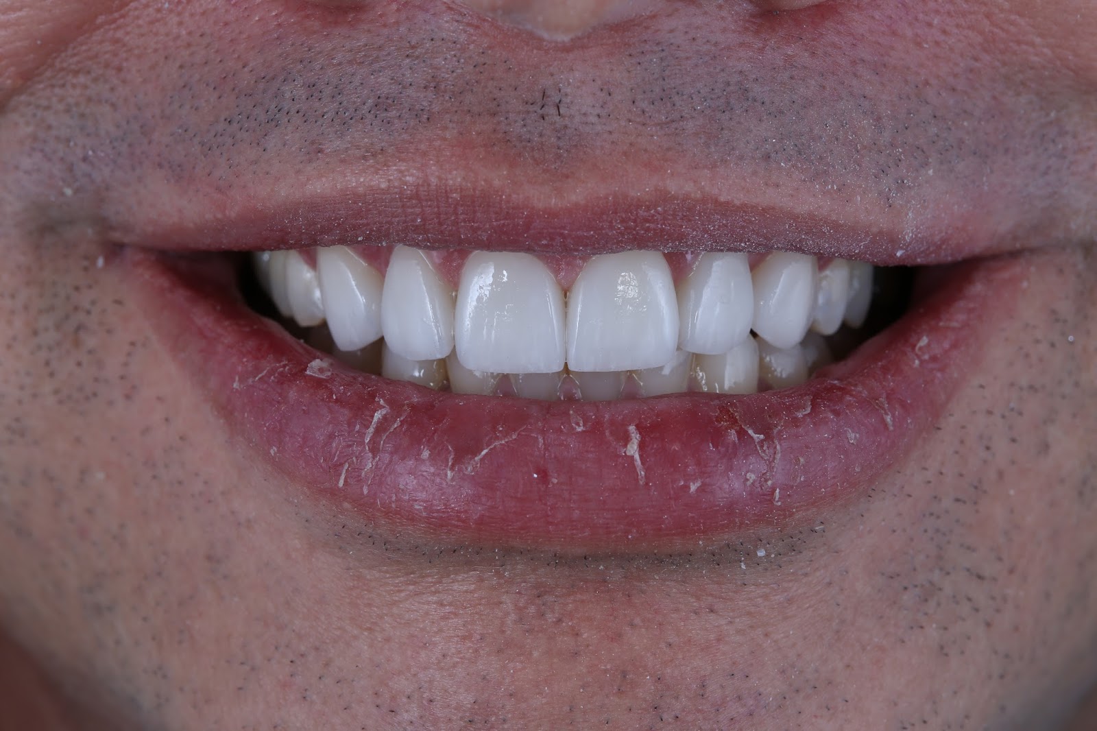 O que é Mock-up dental? ~ Araújo e ginger - Odontologia Estética