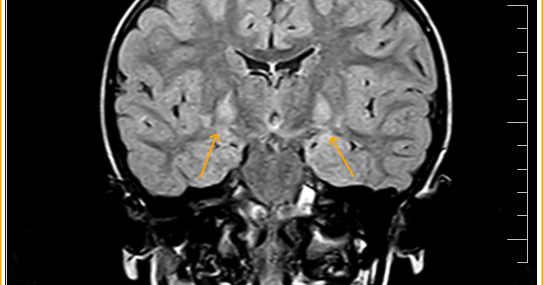 Chronic Kernicterus: MRI - Sumer's Radiology Blog