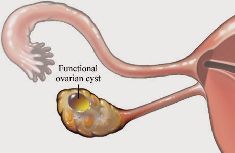 Ovarian Cyst Miracle 101: 10 Truths You Might Not Know About Functional ...