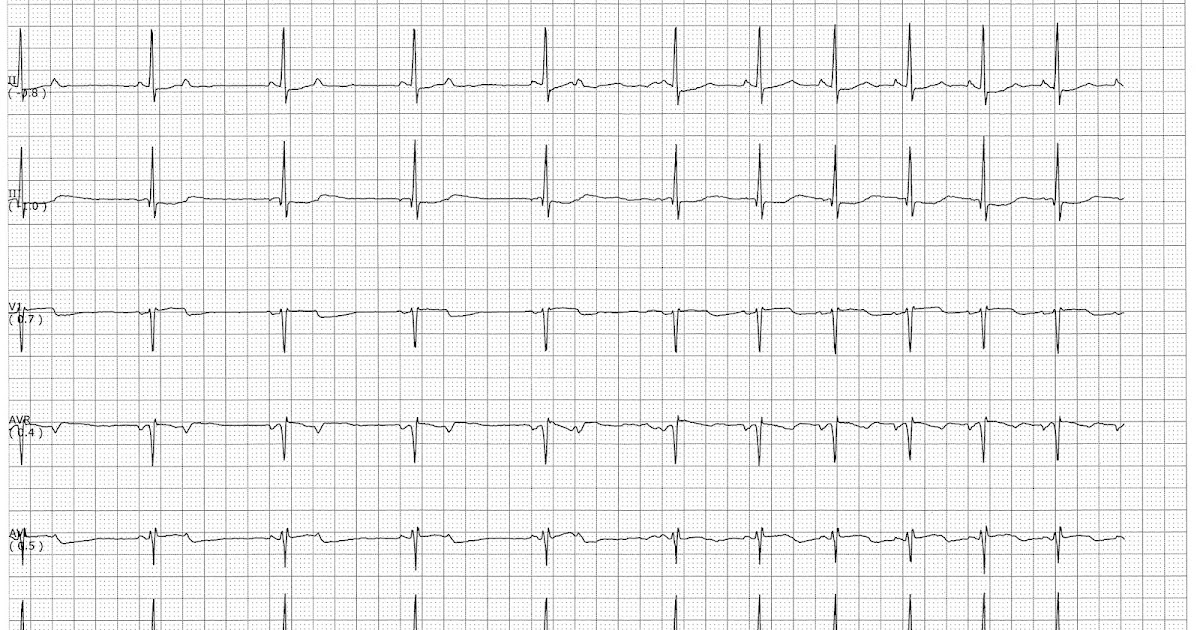 Nonconducted PACs or Sinus arrhythmia