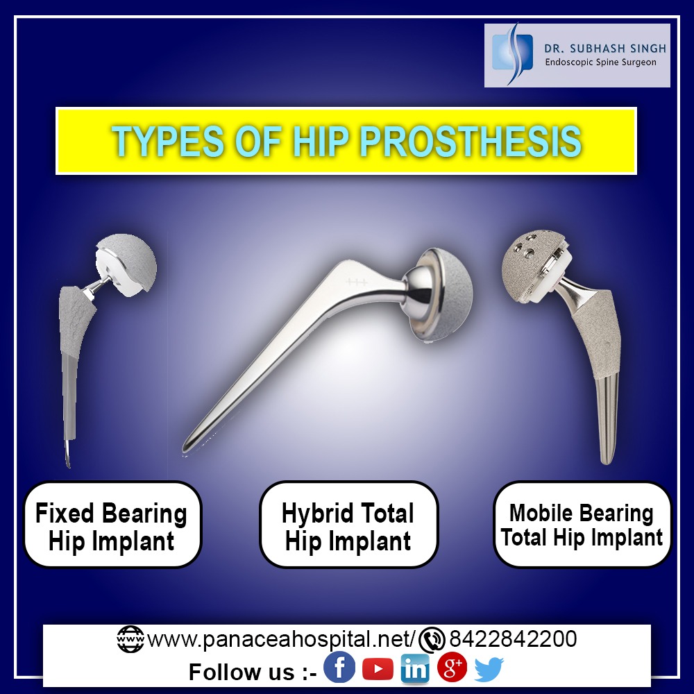 TYPES OF HIP PROSTHESIS