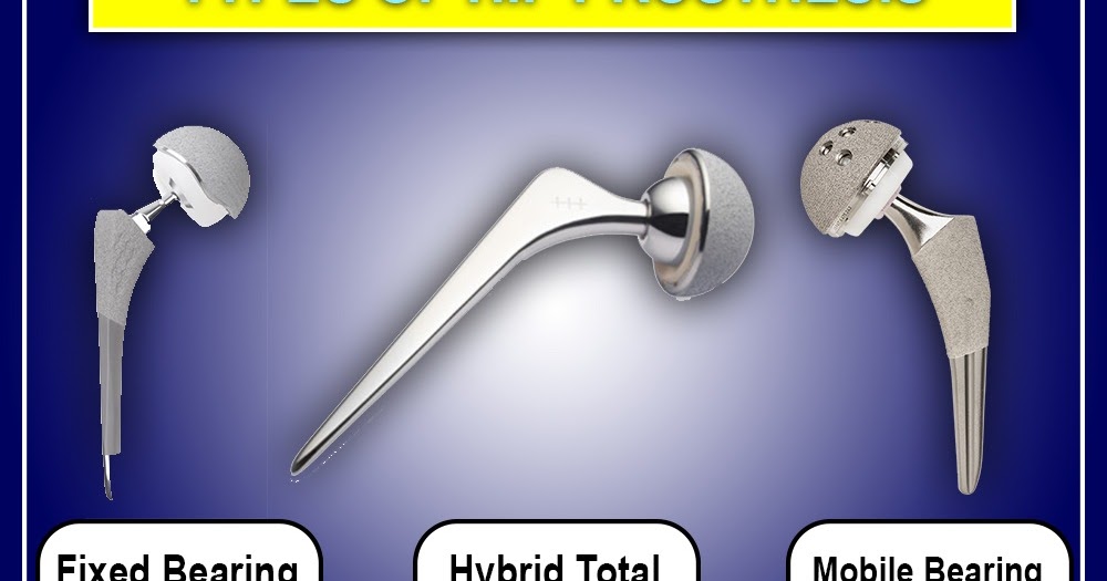 TYPES OF HIP PROSTHESIS