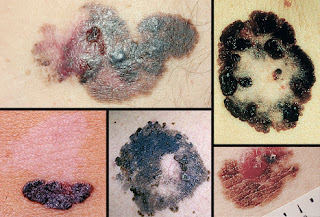 Groin skin cancer in men ~ All about Health
