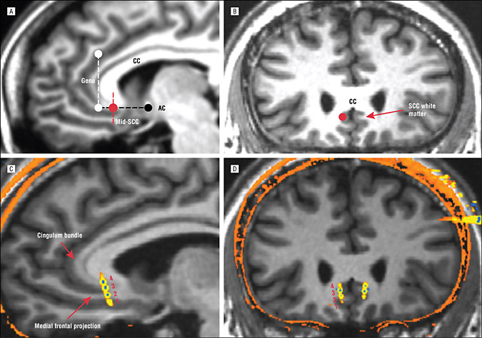 The Neurocritic Deep Brain Stimulation For Bipolar Depression