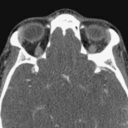 Dr Balaji Anvekar Frcr Orbital Calcifications