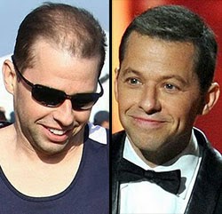 Jon Cryer Hair Transplant