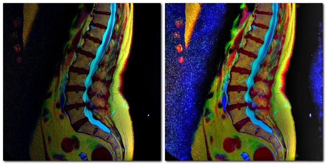 Nevit's blog: Color MRI of the Lumbar spine tonemapped.