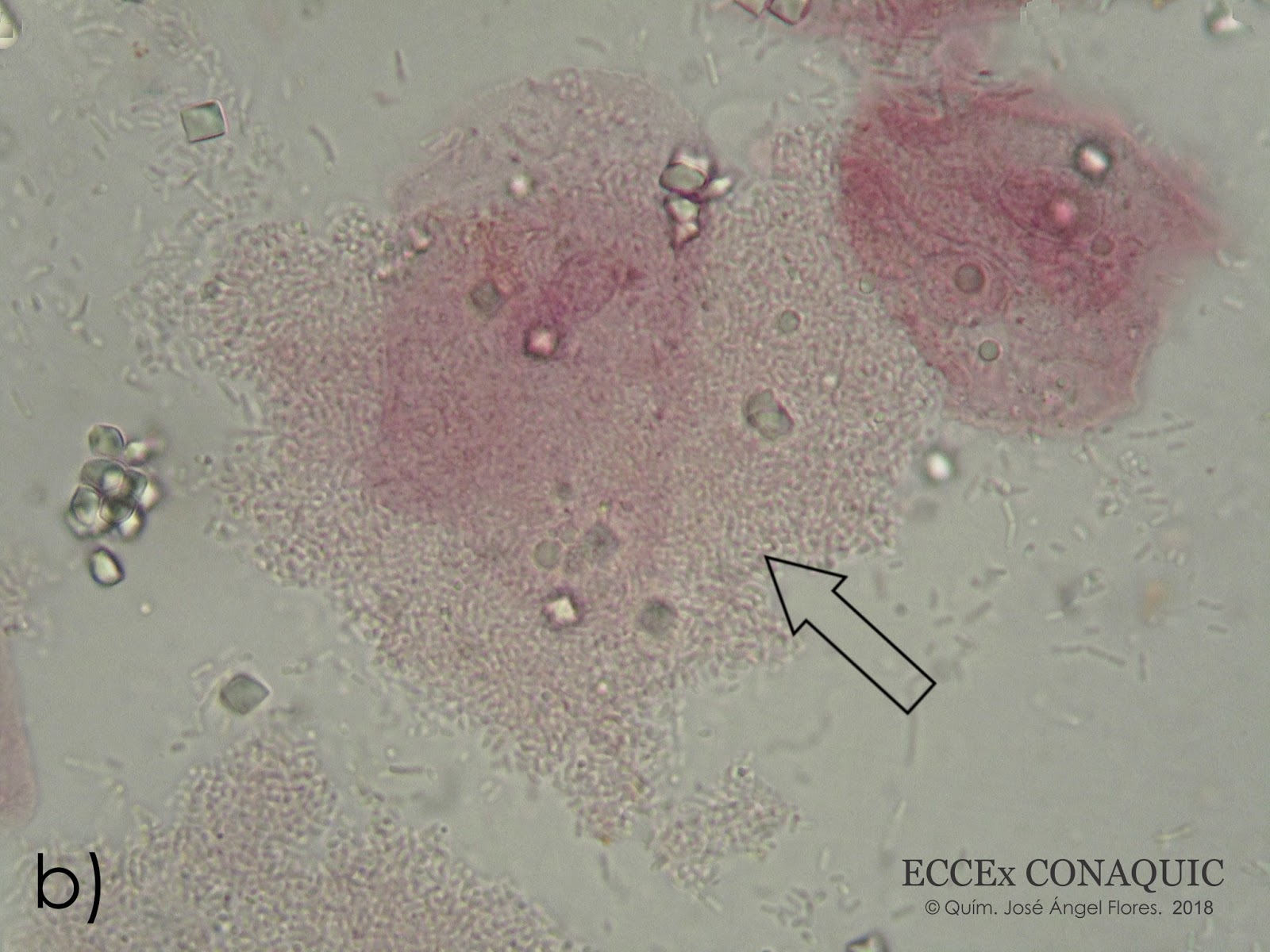 Caso UR-abril-18 (Enfoque: bacteriuria)