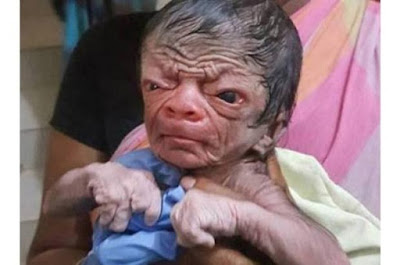 "Benjamin Button" da vida real, conheça o bebê que nasceu com aspecto ...