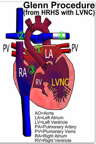 The Christiansen Family: Glenn Shunt :: Leighton's [second] surgery