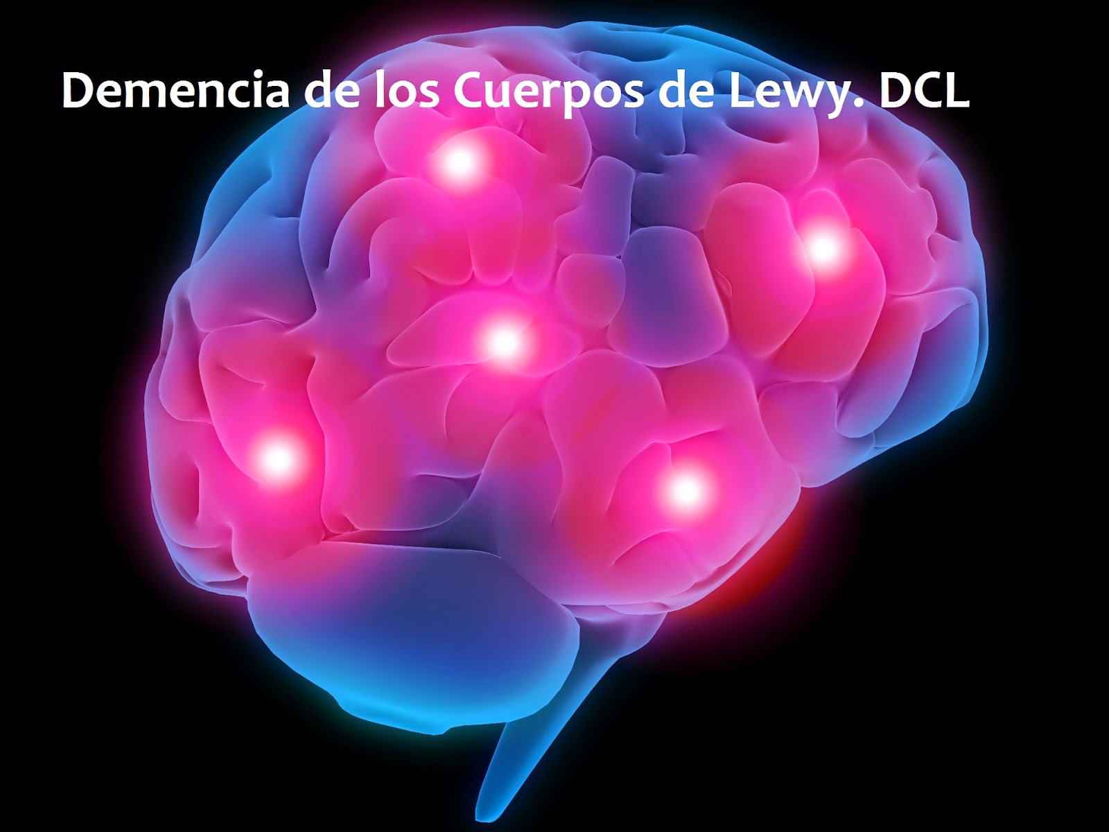 Pura Vida Noticias Que Debemos Saber Del Dcl Demencia De Los Cuerpos