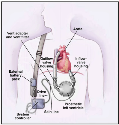 Physiological mechanism of HF and the rescuing treatment LVAD (Left ...
