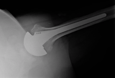 Shoulder and Elbow Surgery: "Bone spurs" and shoulder replacement surgery