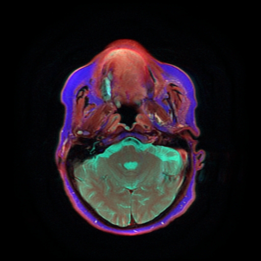 Nevit's blog: Color MRI - Lymphoma of the Neck