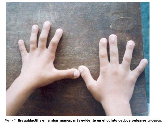 Nuestro esqueleto: Miembro superior: Malformaciones óseas de la mano