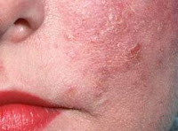 Scabies on the Scalp ~ How to Kill Scabies