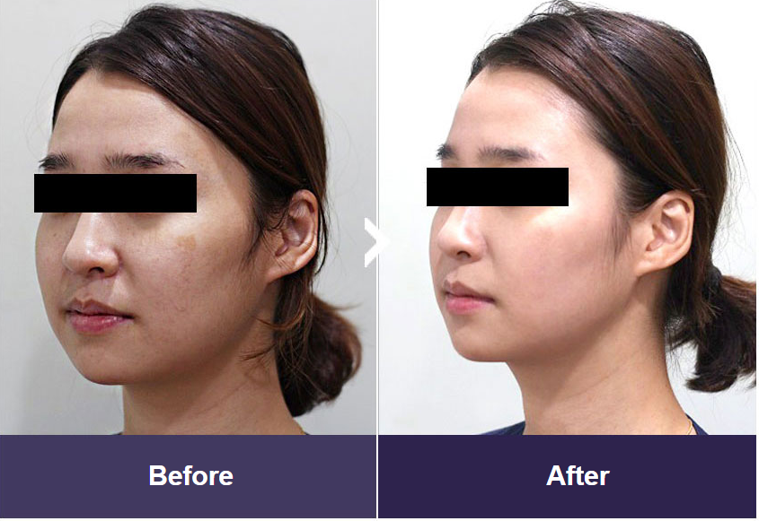 Renewme Skin Clinic: Younger face V-Line, Elasticity and Volume together!
