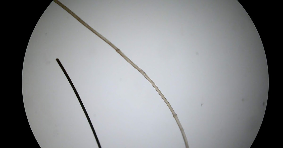 CDPath-Dermatology: Netherton's Syndrome, Bamboo Hair.