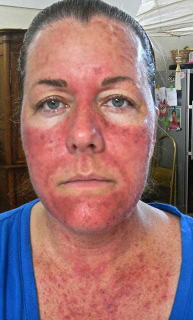 Efudex and Me 2013: Efudex Day Fourteen