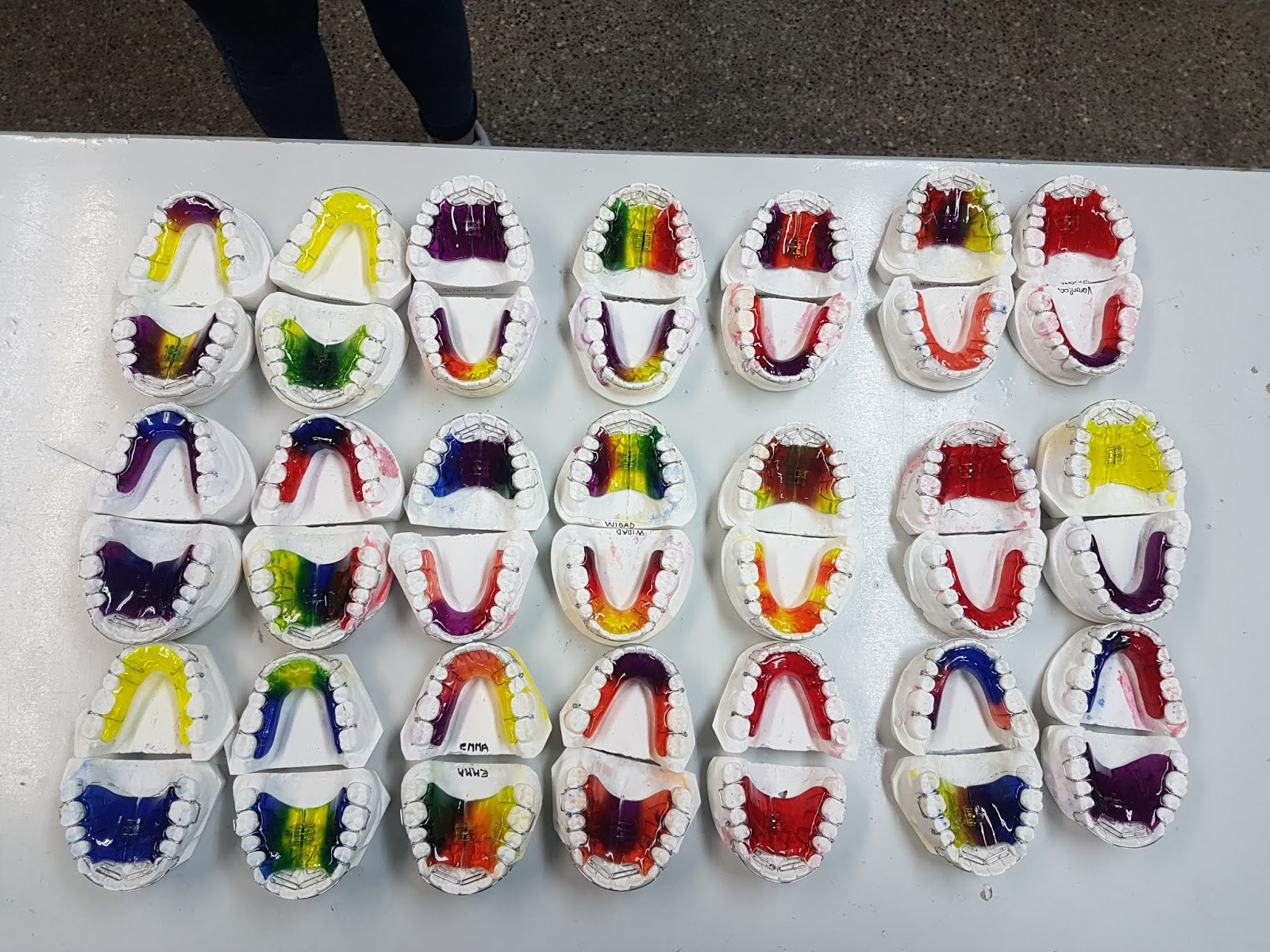 Ortodoncia aplicada a la prótesis dental: Acrilado de la placa Hawley