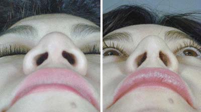 Alar Base Reduction - Reduce nose wings