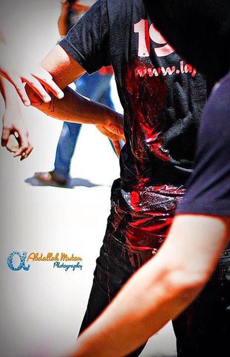 Beitunia Pallywood again: The injury of Mohammed Azza/Azi/Aziz (update ...