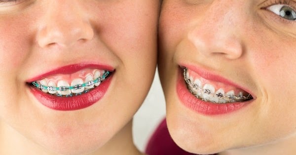 Niềng răng mắc cài kim loại tự buộc có ưu điểm gì? | CẤY IMPLANT