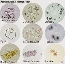 Analis Kesehatan: Pemeriksaan Sedimen Urin