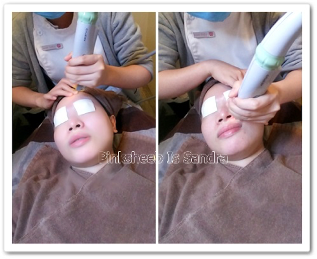 A-PLUS Beauty: (Blogger文分享)改善敏感泛紅肌膚。XEO LASER GENESIS 微秒激光療程 @A-PLUS ...