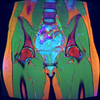Nevit's blog: Coronal Color MRI of Female Pelvis