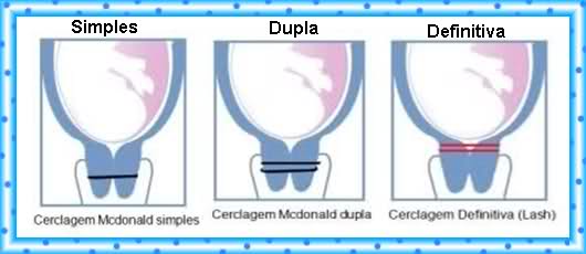 .. Indicado pela mamãe..: Incompetência Istmo cervical ou Insuficiência ...