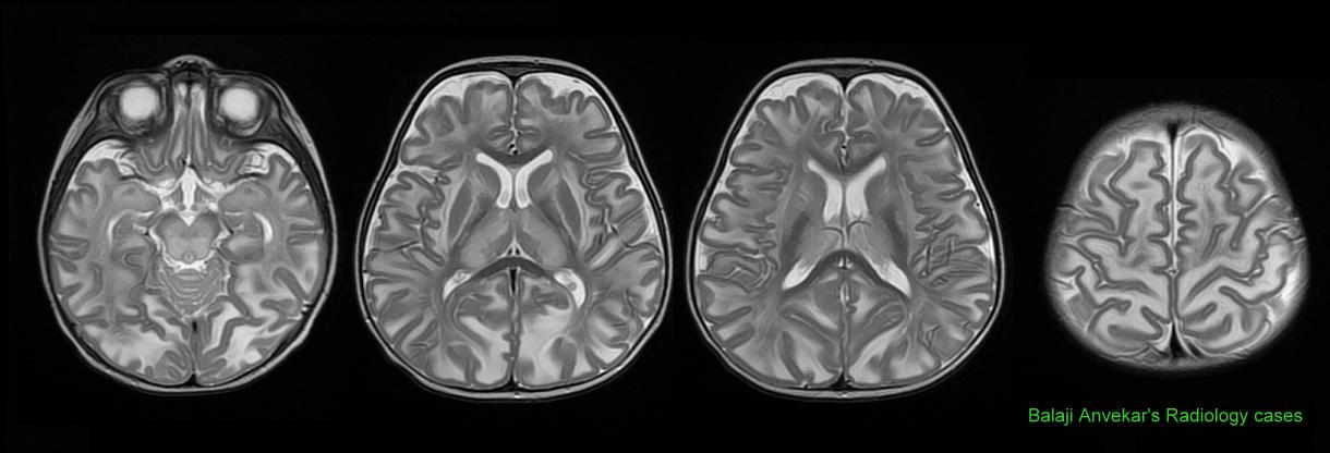 Dr Balaji Anvekar FRCR: Canavan disease MR Spectroscopy