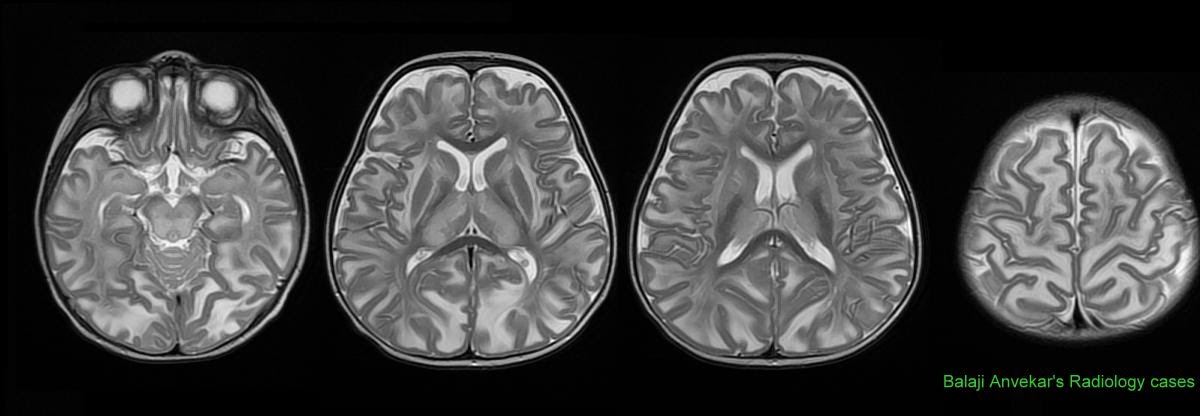 Neuroradiology Cases: Canavan disease MR Spectroscopy